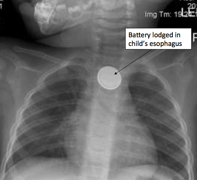 Oklahoma Button Battery Injury Lawyer | Carr & Carr